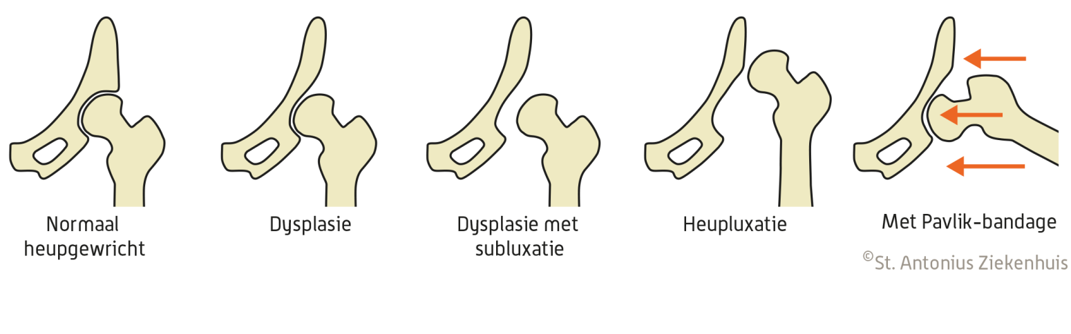 Heupafwijkingen bij pasgeborenen (heupdysplasie) | St. Antonius Ziekenhuis