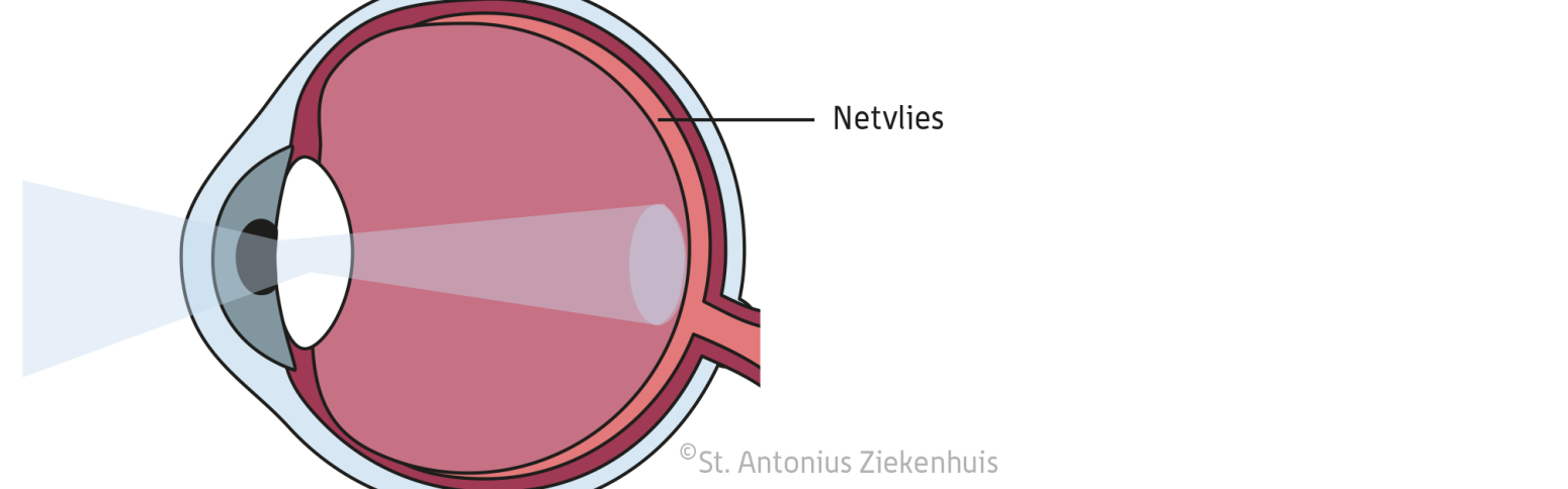 Torische kunstlens staar | St. Antonius Ziekenhuis