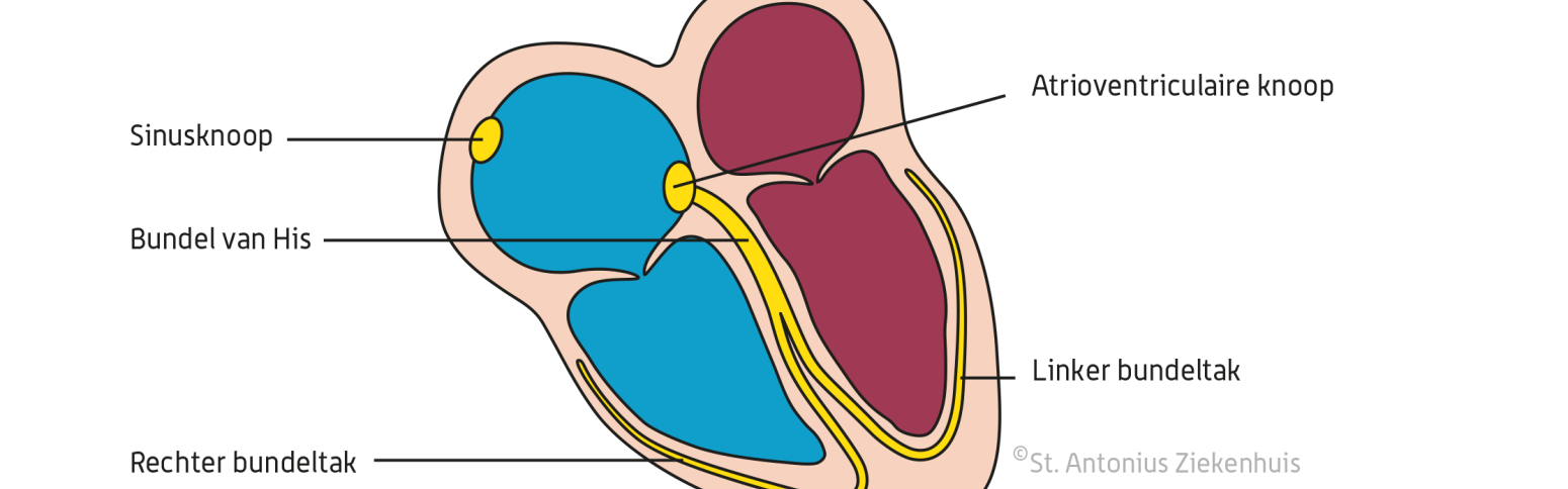 Boezemfibrilleren (atriumfibrilleren) | St. Antonius Ziekenhuis