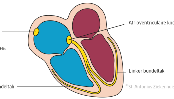 Boezemfibrilleren (atriumfibrilleren) | St. Antonius Ziekenhuis