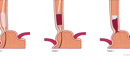 Barrett slokdarm: behandeling met radiofrequente ablatie | St. Antonius ...