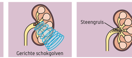 Niersteenvergruizing | St. Antonius Ziekenhuis