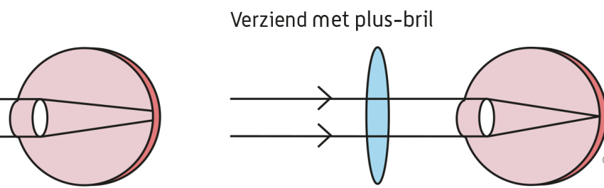 Brilafwijking (Refractieafwijking) | St. Antonius Ziekenhuis