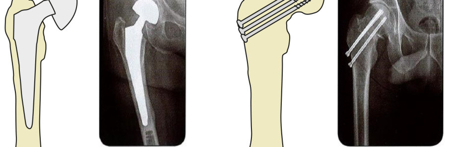 Fysiotherapie na een heupfractuur | St. Antonius Ziekenhuis