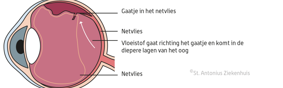 Netvliesloslating | St. Antonius Ziekenhuis