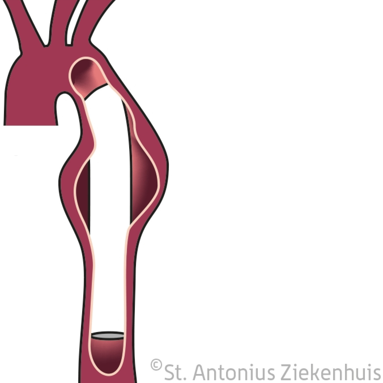 Thoracale endoprothese | St. Antonius Ziekenhuis