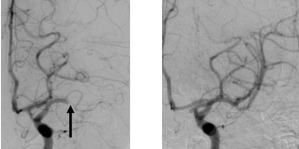 Weghalen oorzaak herseninfarct bij veel patiënten tot 24 uur later nog ...
