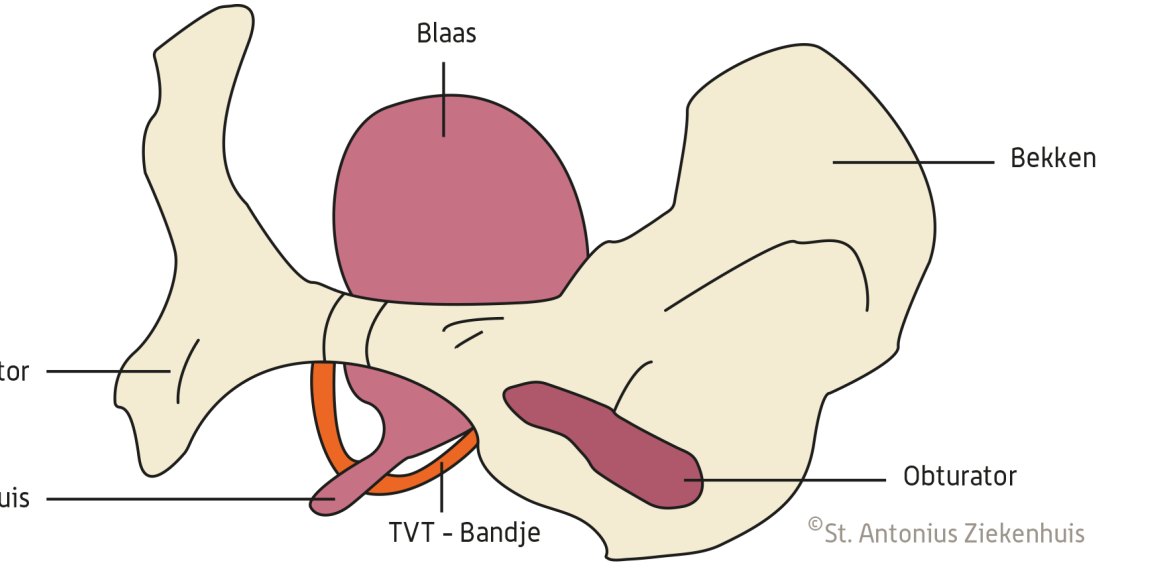 TVT-operatie bij inspanningsincontinentie | St. Antonius Ziekenhuis