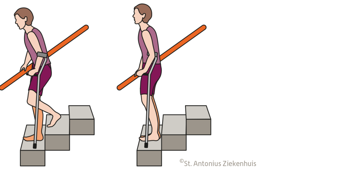 Fysiotherapie na een knieprothese | St. Antonius Ziekenhuis