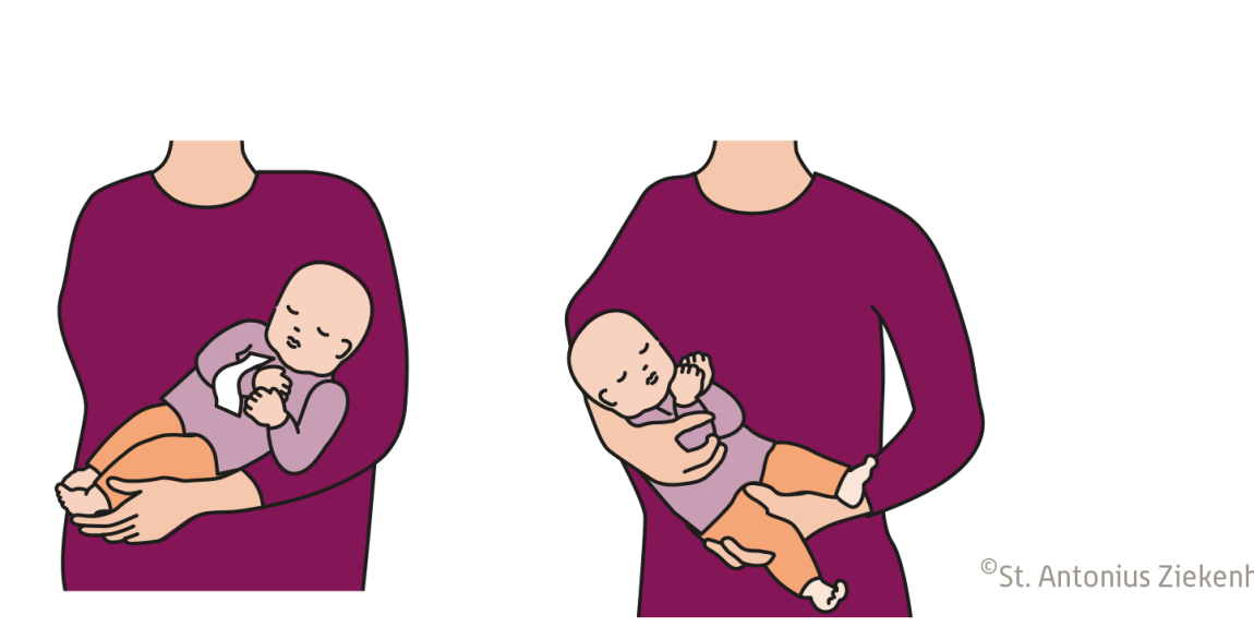 Baby geboren met een schouderdystocie en/of gebroken sleutelbeentje | St. Antonius Ziekenhuis