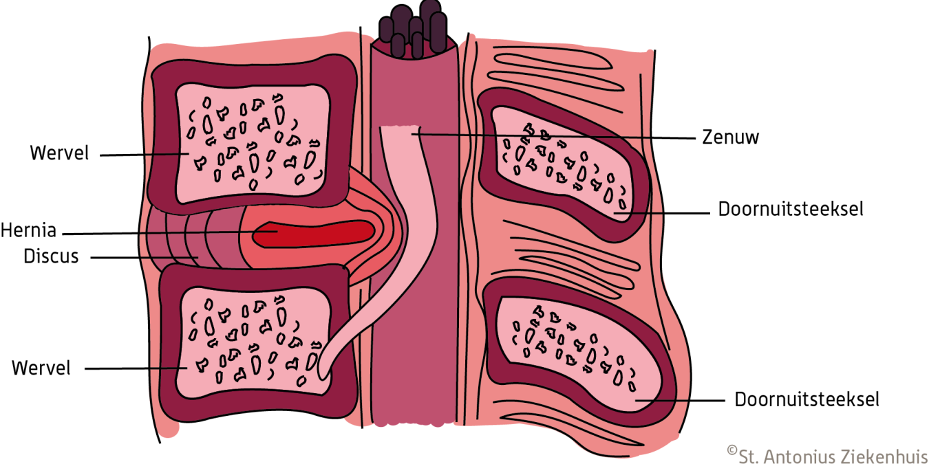 Herniaoperatie lage rug | St. Antonius Ziekenhuis