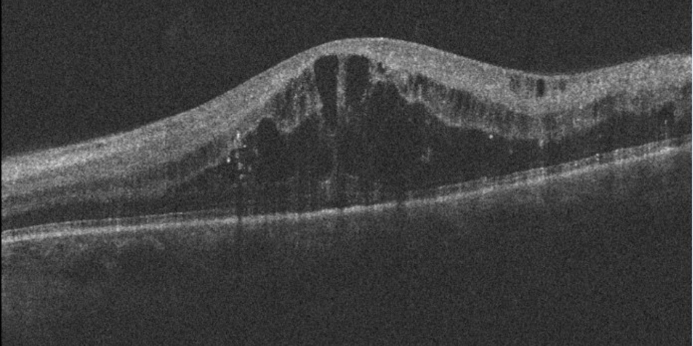OCT (Optical Coherence Tomograaf) | St. Antonius Ziekenhuis