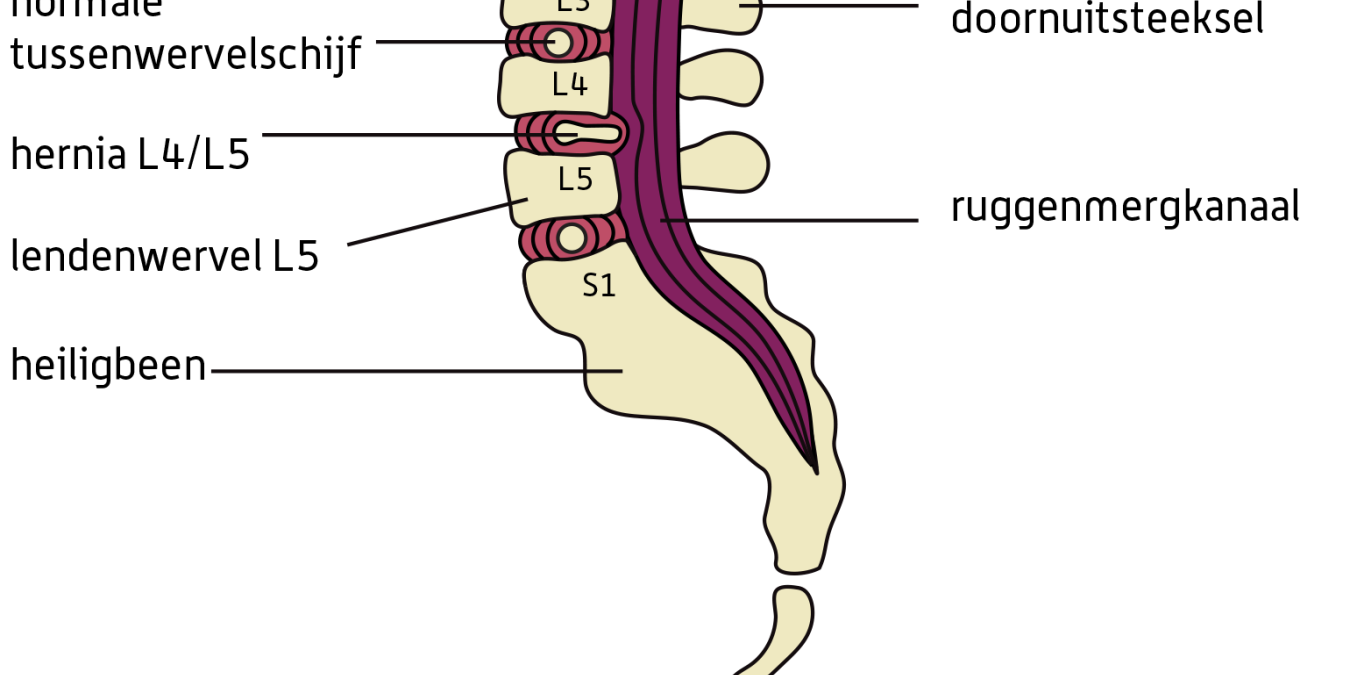 Herniaoperatie lage rug | St. Antonius Ziekenhuis