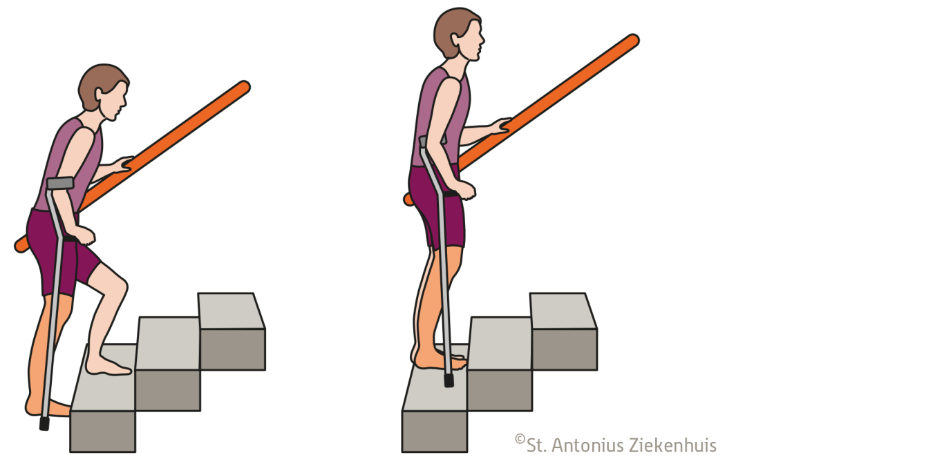 Fysiotherapie na een knieprothese | St. Antonius Ziekenhuis