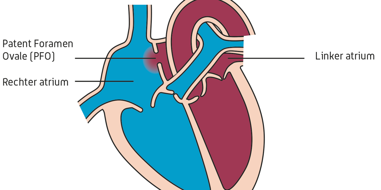 Het sluiten van Patent Foramen Ovale (PFO) | St. Antonius Ziekenhuis