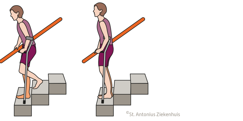 Oefenadvies na een hallux valgus operatie | St. Antonius Ziekenhuis
