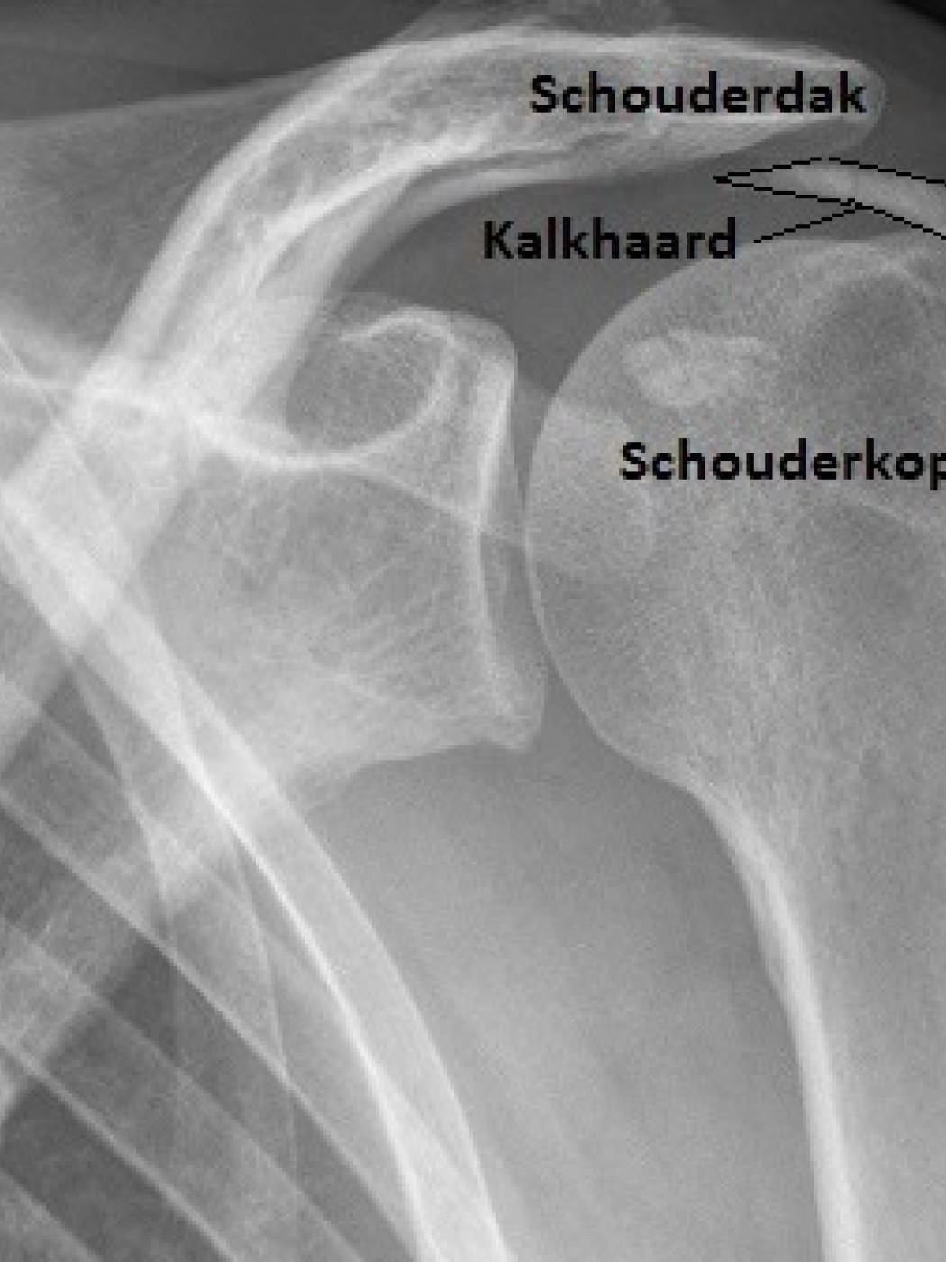 Verkalking van de schouder (tendinitis calcarea) | St. Antonius Ziekenhuis