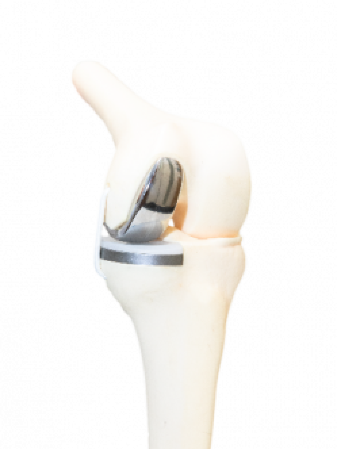 Unicondylaire knieprothese | St. Antonius Ziekenhuis