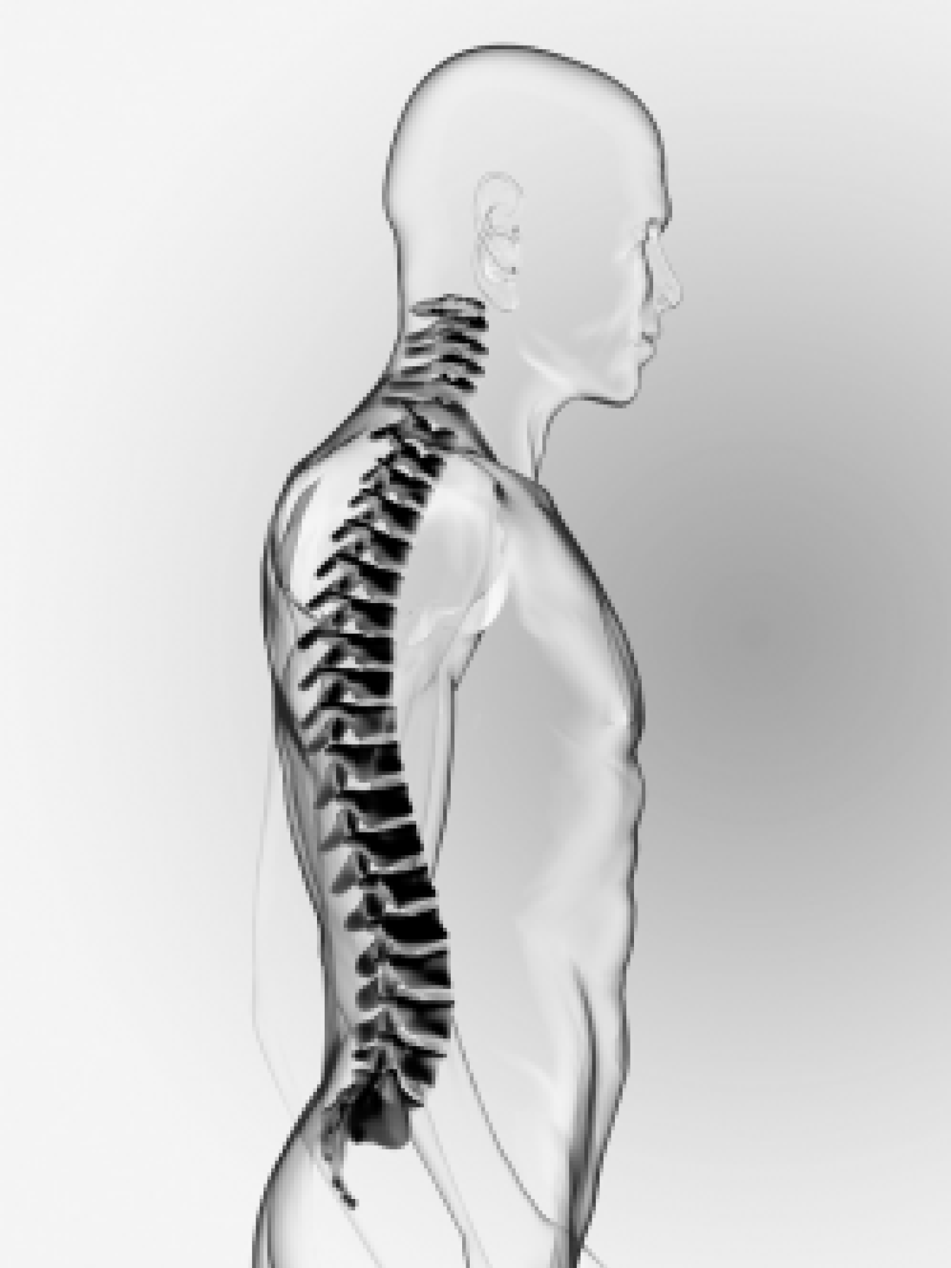 Scoliose | St. Antonius Ziekenhuis