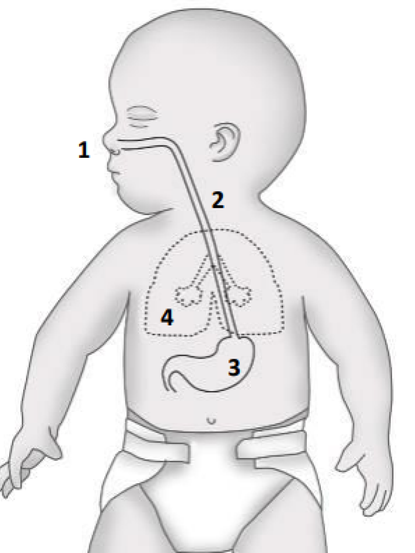 Leren sondevoeding geven | St. Antonius Ziekenhuis
