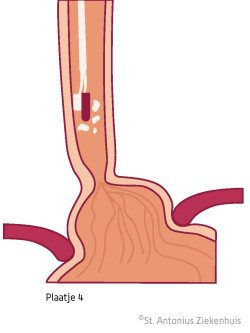 Barrett slokdarm: behandeling met radiofrequente ablatie | St. Antonius ...