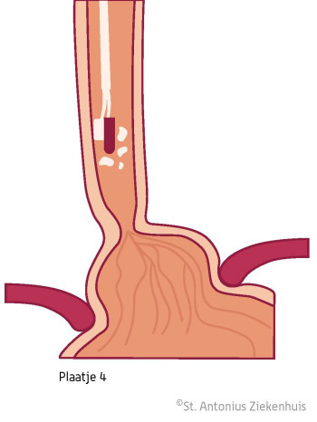 Barrett slokdarm: behandeling met radiofrequente ablatie | St. Antonius ...