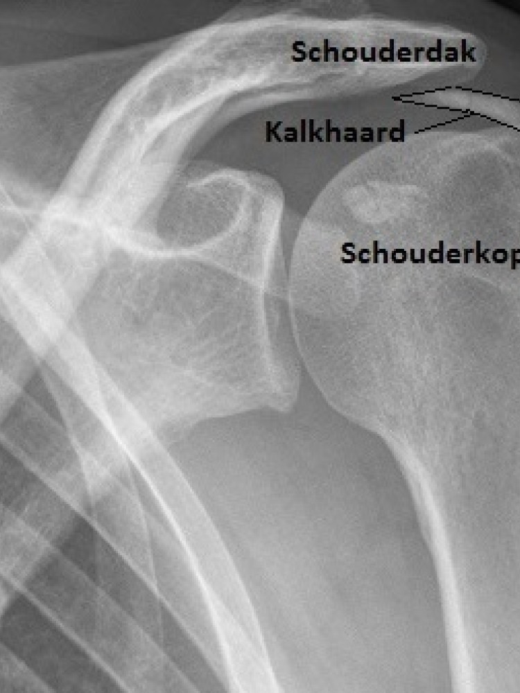 Verkalking van de schouder (tendinitis calcarea) | St. Antonius Ziekenhuis