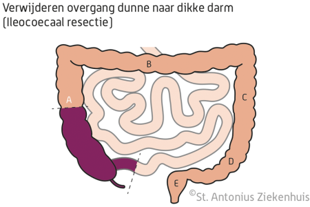 Darmoperatie | St. Antonius Ziekenhuis
