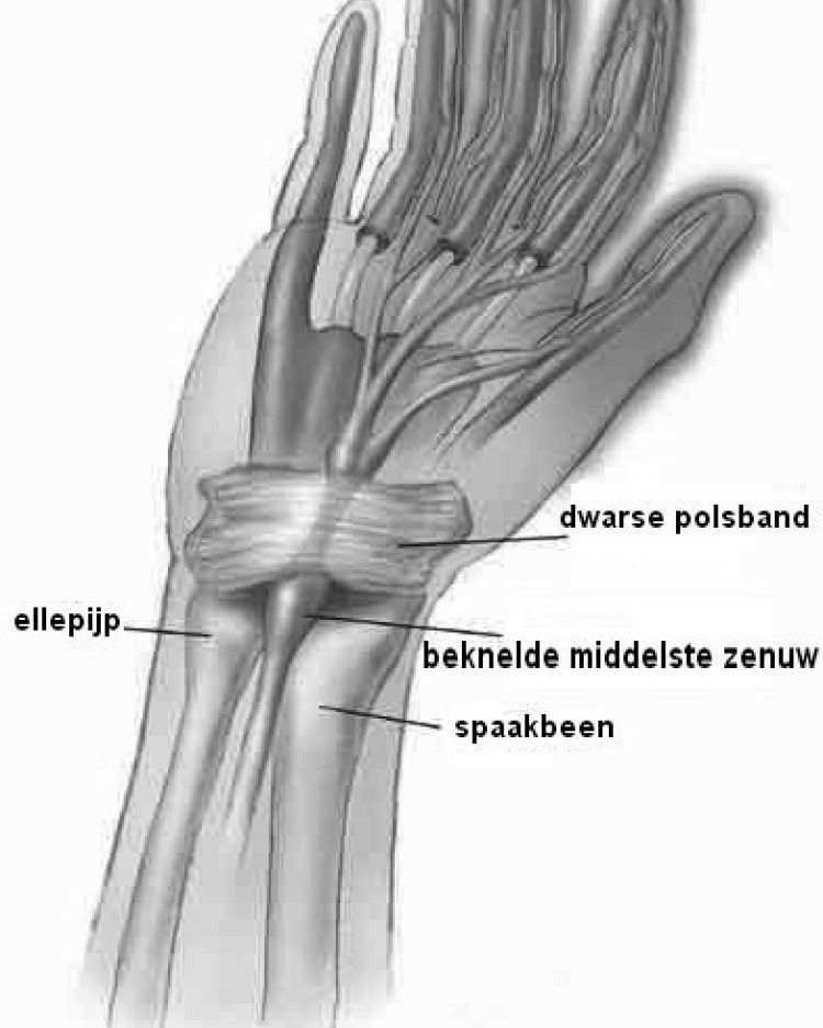 Carpale tunnelsyndroom (CTS) | St. Antonius Ziekenhuis