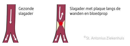 Hartinfarct (Myocardinfarct) | St. Antonius Ziekenhuis