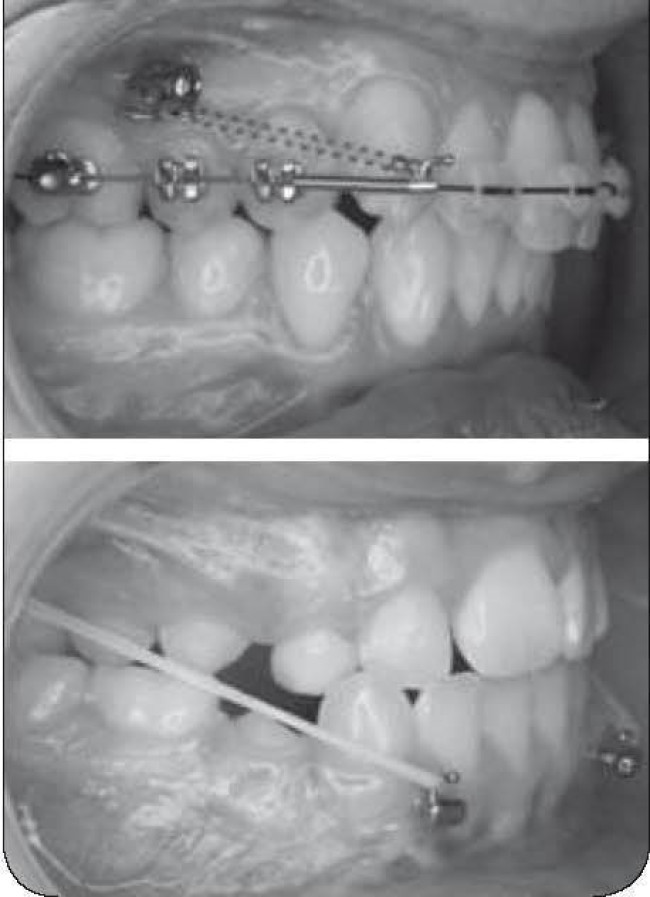 Botanker of orthodontisch schroefje plaatsen en verwijderen | St ...