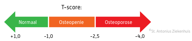 Osteoporose (botontkalking) | St. Antonius Ziekenhuis