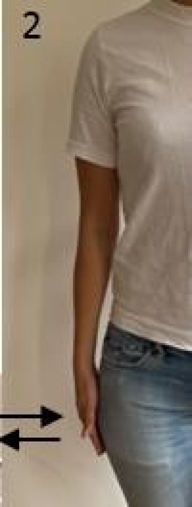 Dislocated collarbone | St. Antonius Ziekenhuis