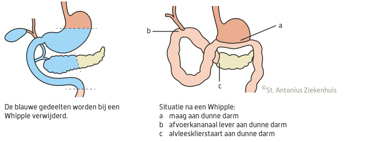 Dieetadvies na een Whipple operatie | St. Antonius Ziekenhuis