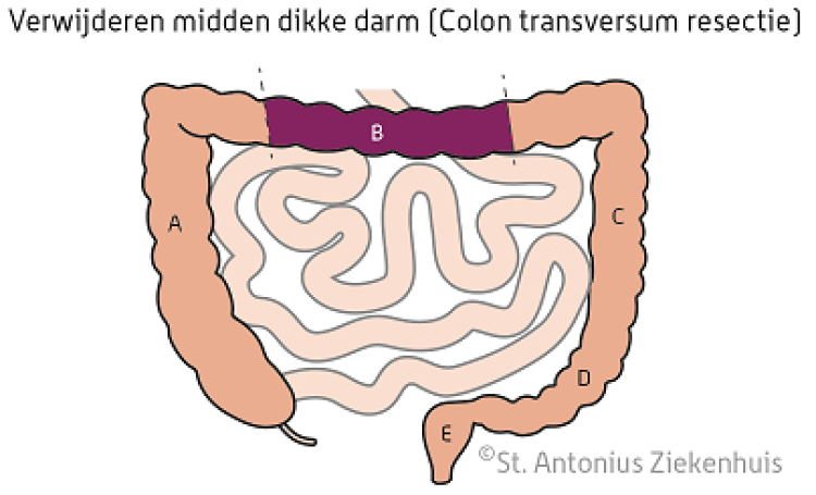 Darmoperatie | St. Antonius Ziekenhuis