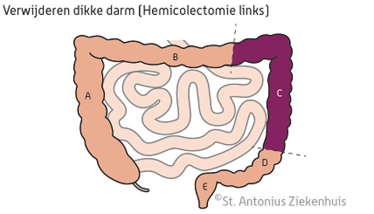 Darmoperatie | St. Antonius Ziekenhuis