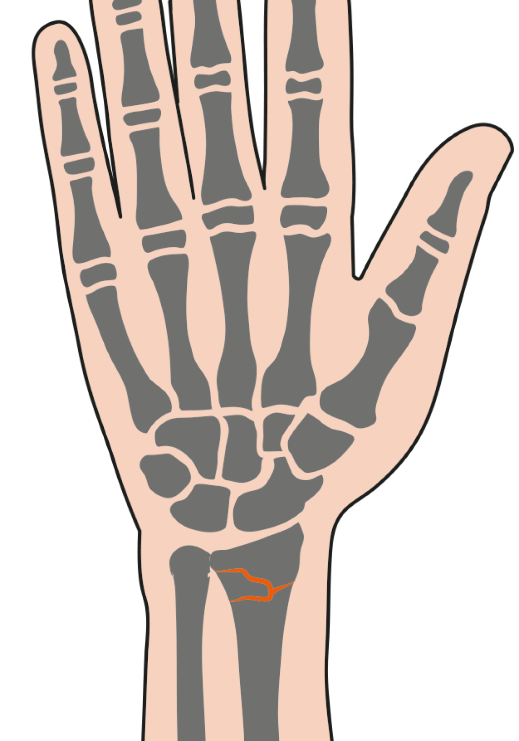 Gebroken pols bij volwassenen | St. Antonius Ziekenhuis