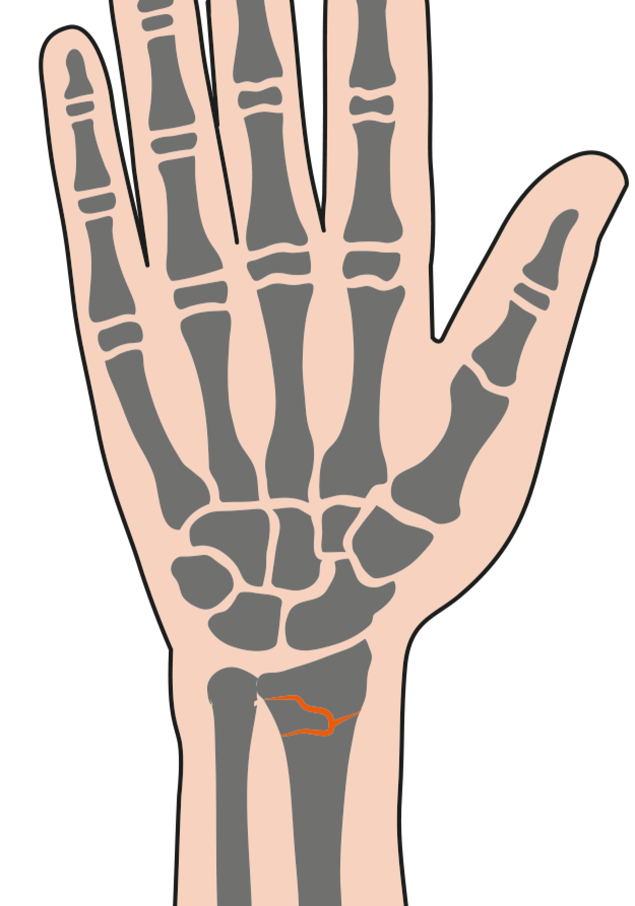 Gebroken pols bij volwassenen | St. Antonius Ziekenhuis