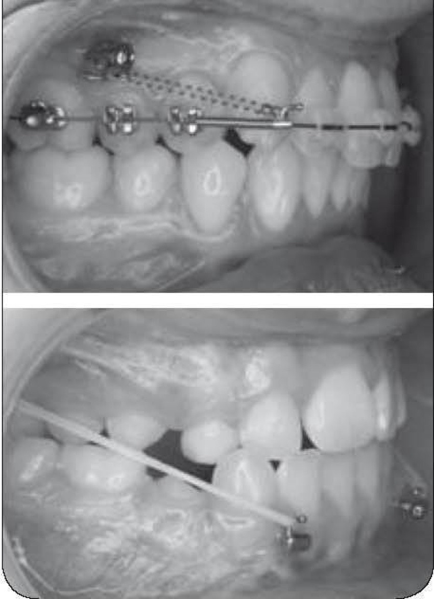 Botanker of orthodontisch schroefje plaatsen en verwijderen | St ...