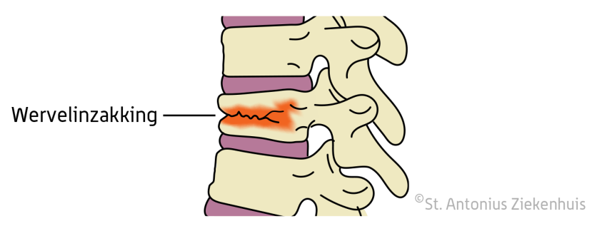 Osteoporose (botontkalking) | St. Antonius Ziekenhuis