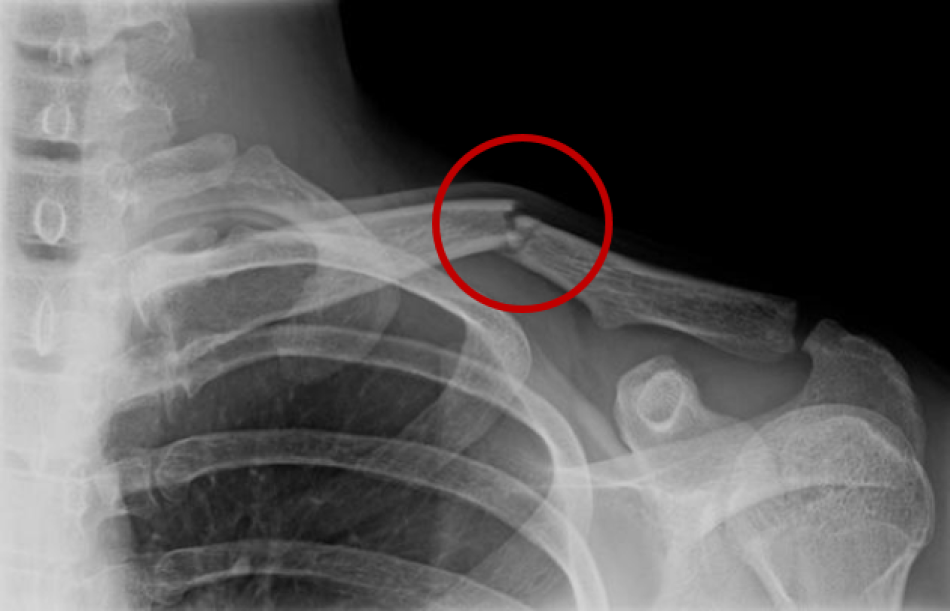Broken collarbone in adults | St. Antonius Ziekenhuis