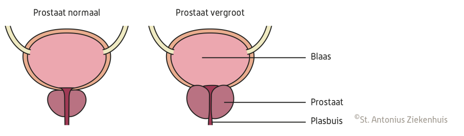 Prostaatkanker (prostaatcarcinoom) | St. Antonius Ziekenhuis